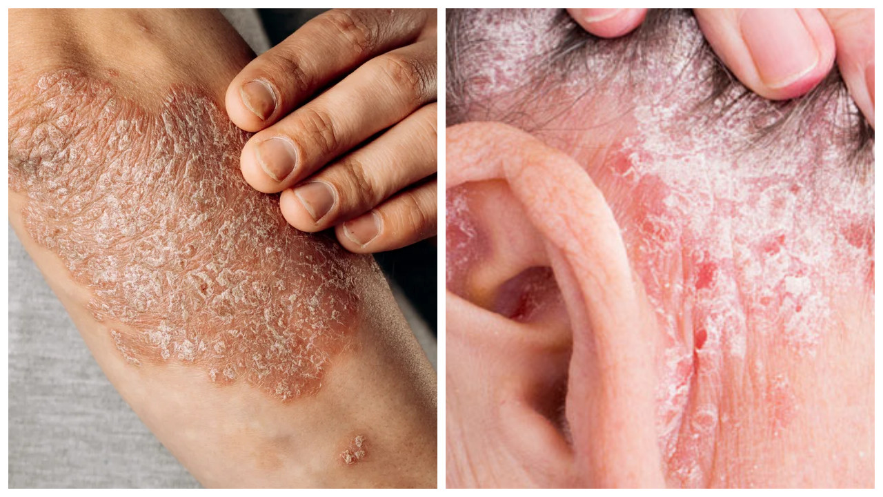 Inilah Kenali 6 Jenis Penyakit Kulit dan Cara Mengatasinya Yang Wajib Anda Tahu!